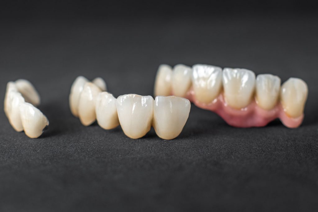 Teeth Replacement Options - Alpine Dental Implant